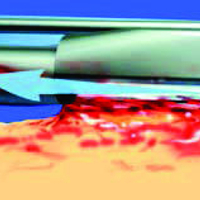 VERSAJET III Hydrosurgery System for wound debridement