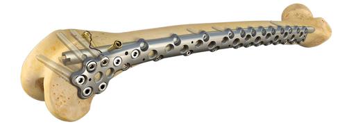 EVOS LARGE & PERIPROSTHETIC Plating System | Smith+Nephew Global