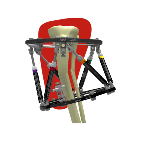 SMART TSF Circular Fixator | Smith+Nephew Global