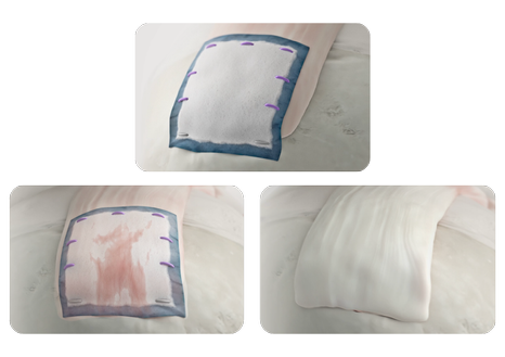 REGENETEN Bioinductive Implant | Smith+Nephew Australia