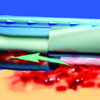 VERSAJET III Hydrosurgery System for wound debridement