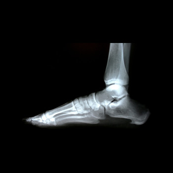 SALTO TALARIS Total Ankle Prosthesis | Smith+Nephew Global