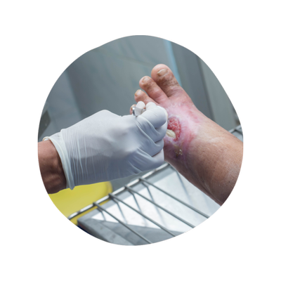 PICO Single Use Negative Pressure Wound Therapy System | Smith+Nephew USA