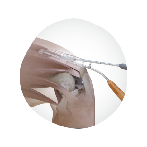 QUADTRAC Quadriceps Tendon Harvest Guide System | Smith+Nephew Global