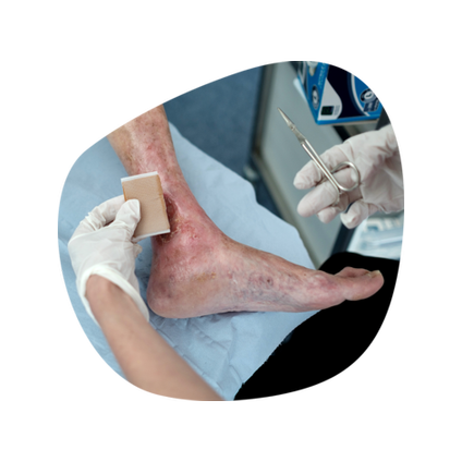 IODOSORB Cadoxemer Iodine | Smith+Nephew USA